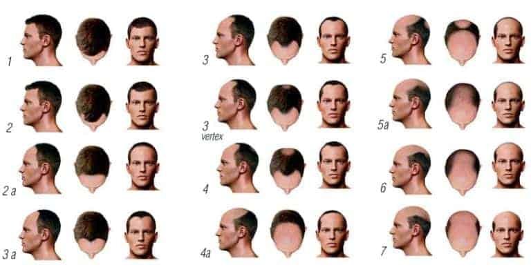 10 Best Haircuts And Hairstyles For Balding Men - Too Manly